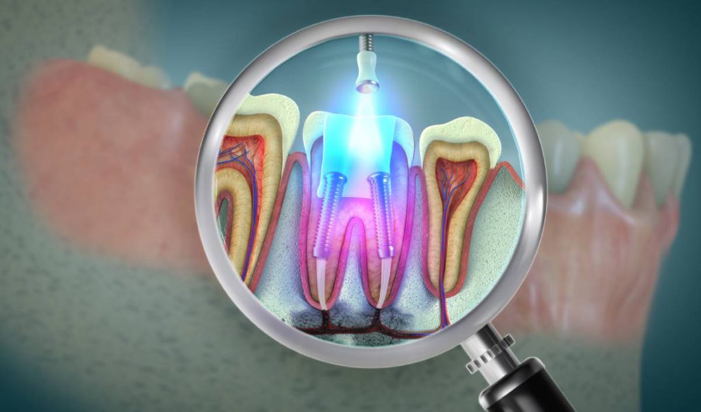 How Is a Root Canal Performed? | Alta Dental Care